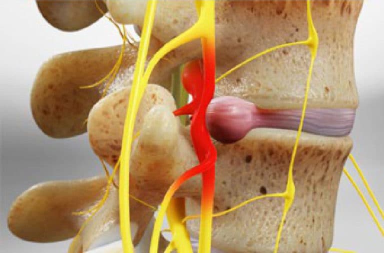 Neurosurgery in Columbus, OH - Axis Spine Clinic